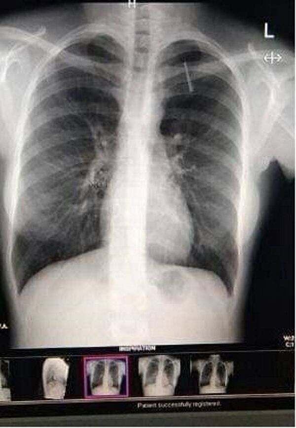 Woman's lung pierced by sewing needle in bizarre accident