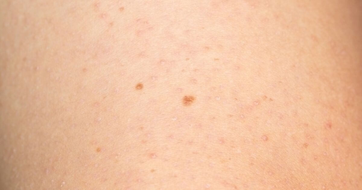 The Skin Nerd: That dreaded common issue... chicken skin