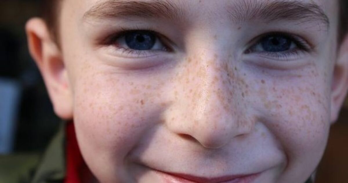 Appliance of Science: How and why do we get freckles?