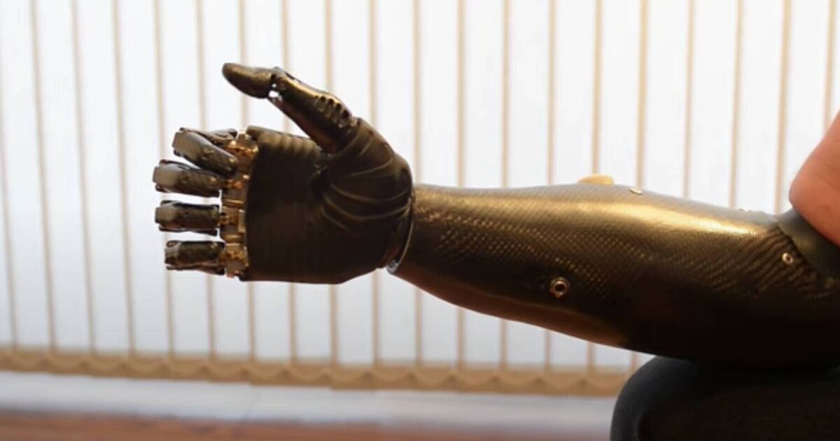 Cork student born without right arm sets up fundraiser for a bionic ...