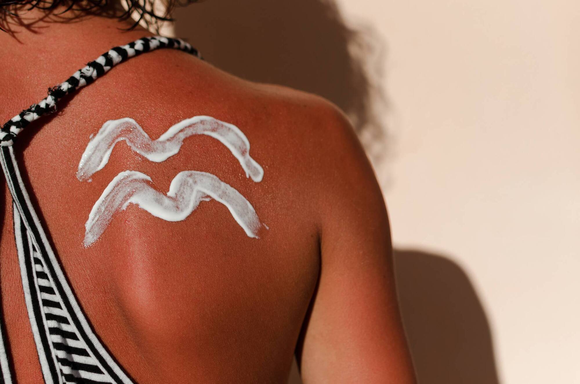 Too much sun exposure over the weekend? Here are five ways to soothe ...