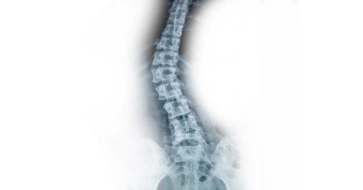 Review into surgical rods used in scoliosis patients 'near completion'