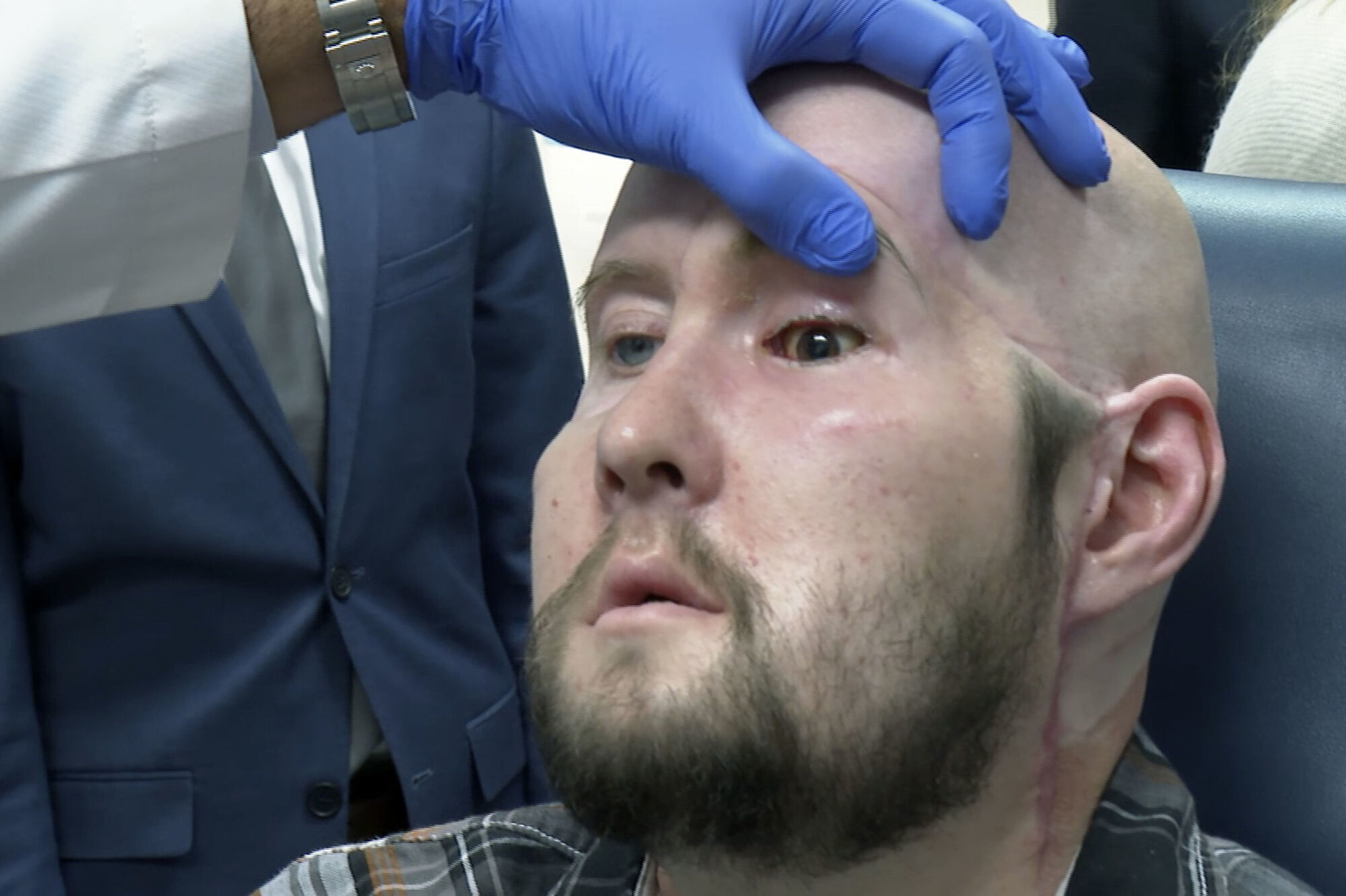 Surgeons perform world's first eye transplant on man who suffered ...