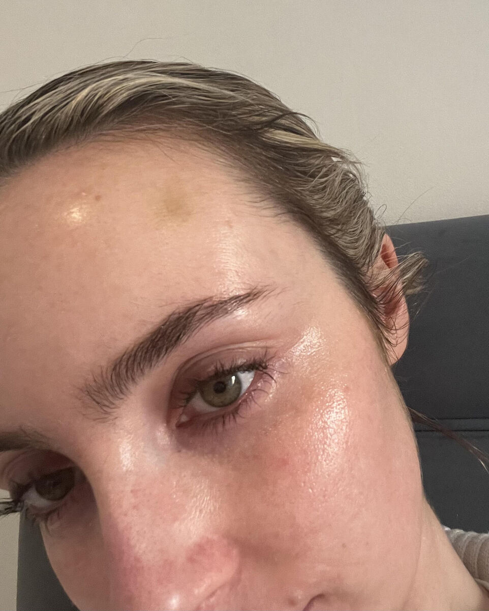 Baby Botox is the entryway to injectables – but is the €300 treatment ...