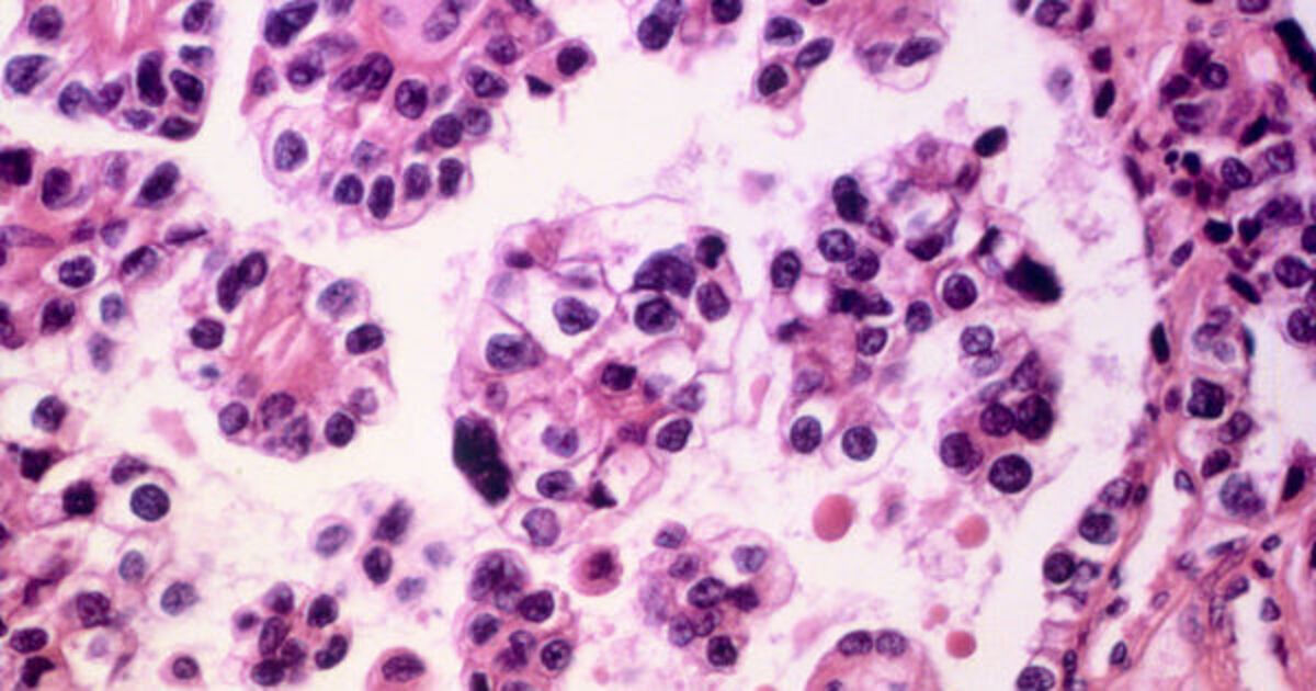 Cervical cancer should be eliminated in Ireland by 2050 - expert