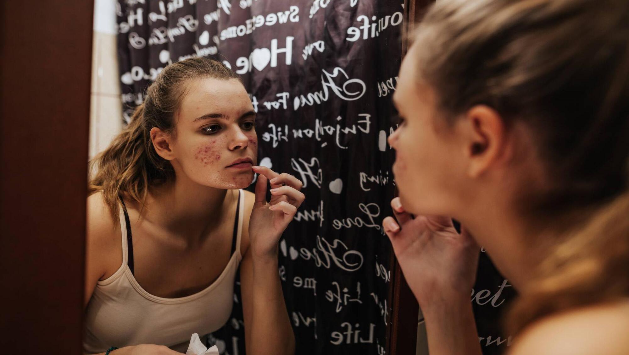 The Skin Nerd: Here's my guide to taking action for acne