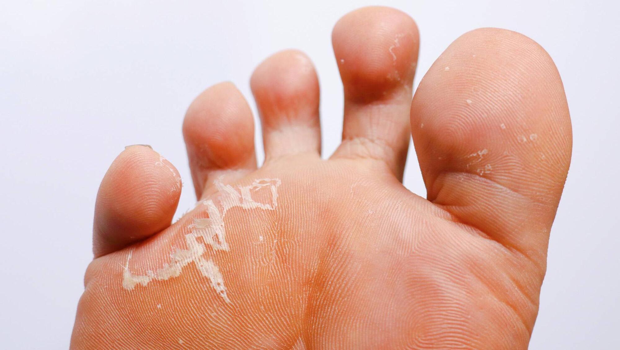 Natural Health: What can I do about my teenagers' athlete's foot?